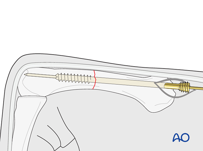 Intramedullary screw fixation for Simple transverse fracture of the ...