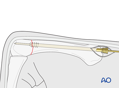 Intramedullary screw fixation for Extraarticular fracture of the distal ...