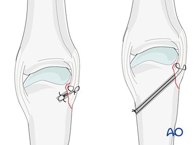 Collateral ligament reattachment for Articular fracture of the distal ...