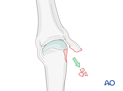 Collateral ligament reattachment for Articular fracture of the distal ...