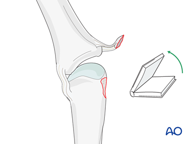Collateral ligament reattachment for Articular fracture of the distal ...