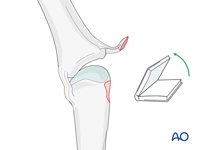 Collateral ligament reattachment for Articular fracture of the distal ...