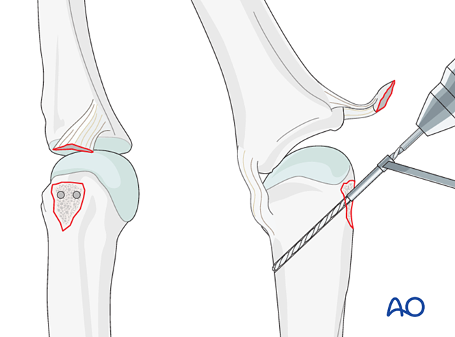 Collateral ligament reattachment for Articular fracture of the distal ...