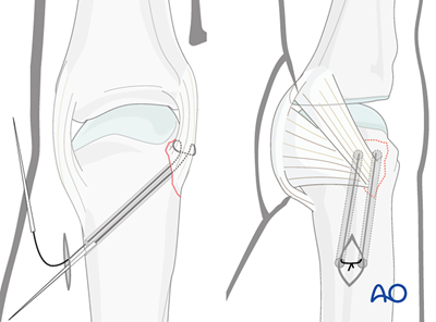 Collateral ligament reattachment for Articular fracture of the distal ...
