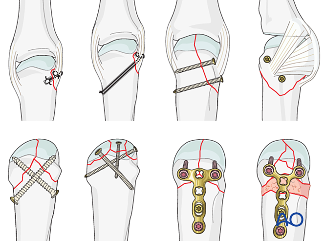ORIF for Dislocation and fracture-dislocation of the ...