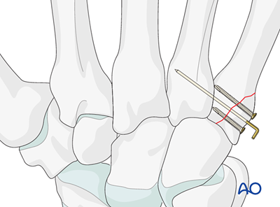 ORIF for Dislocation and fracture-dislocation of the carpometacarpal joint