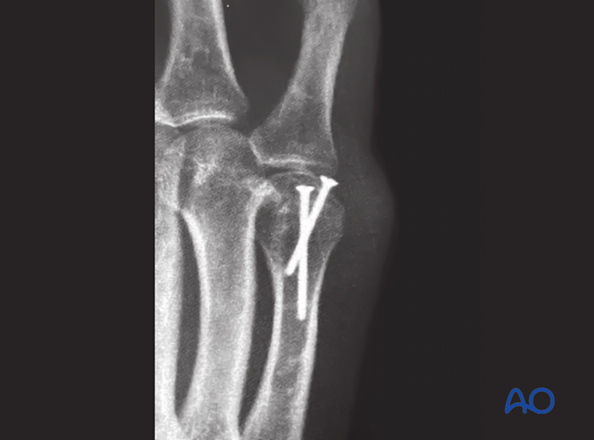 Complications and technical failures