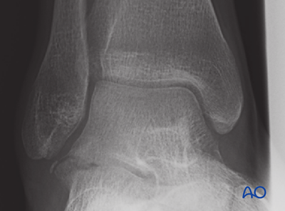 Lateral process