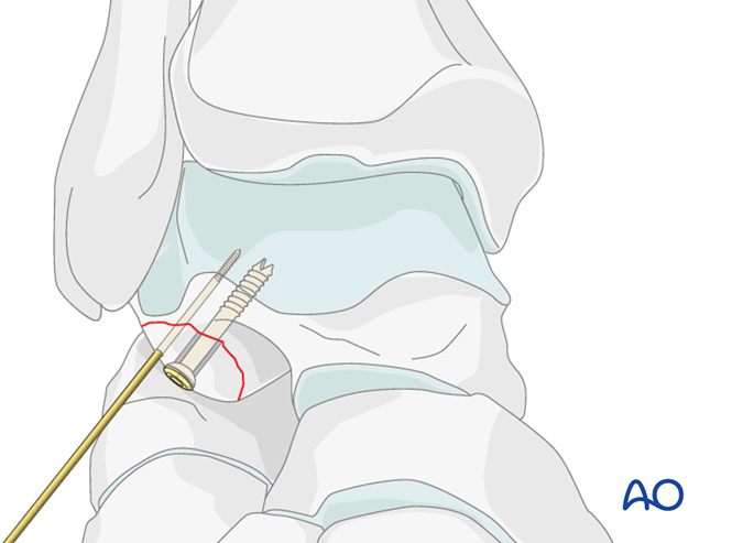 ORIF - Screw fixation for Lateral process