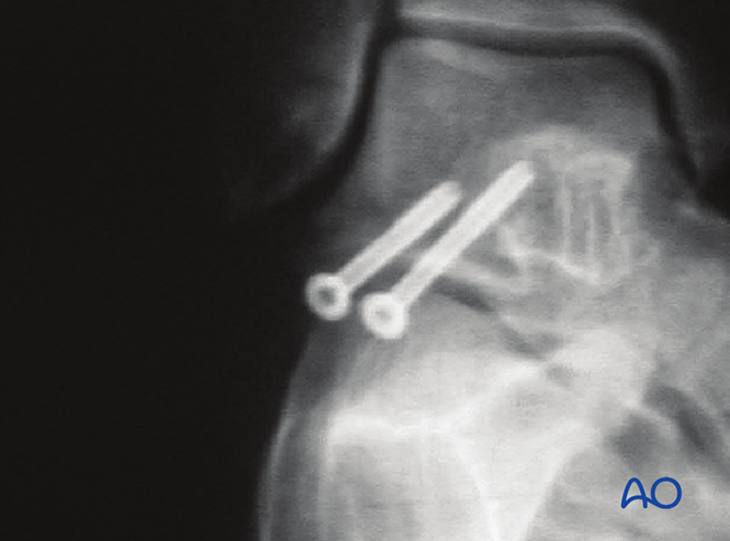 ORIF - Screw fixation for Lateral process