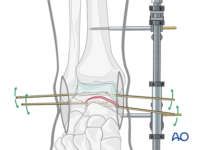 ORIF - Screw fixation for Neck, displaced