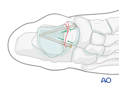 ORIF - Screw fixation for Neck, displaced