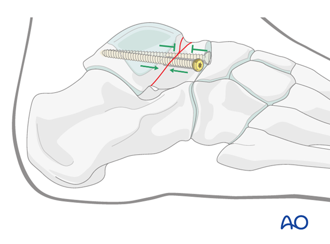 ORIF - Screw fixation for Neck, displaced
