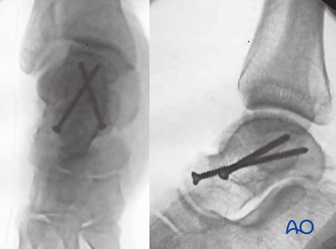 ORIF - Screw fixation for Neck, displaced