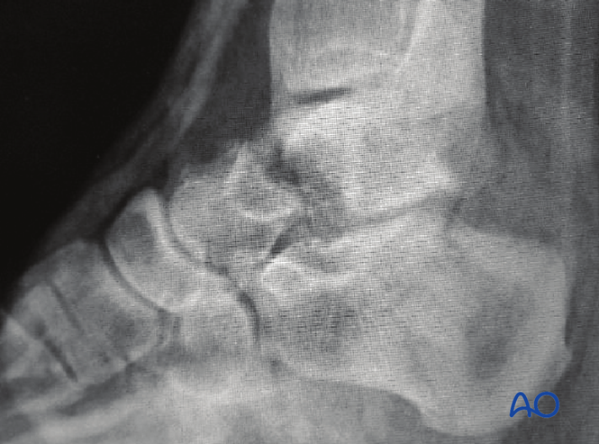 ORIF - Plate fixation for Neck, multifragmentary