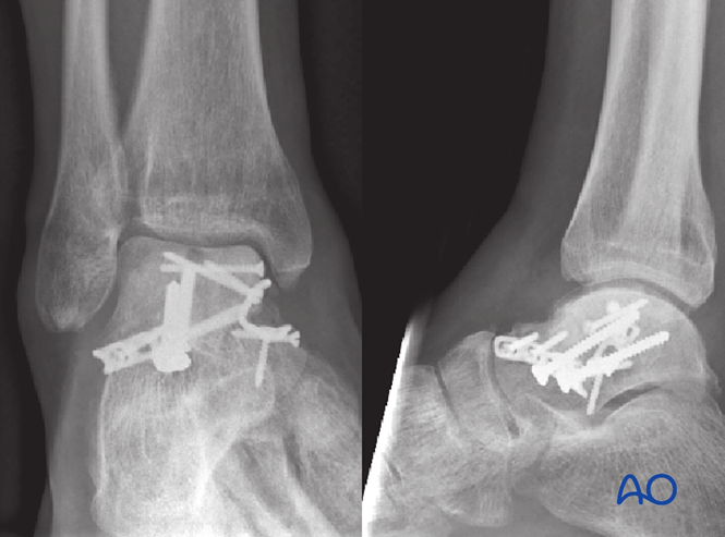 ORIF - Plate fixation for Neck, multifragmentary