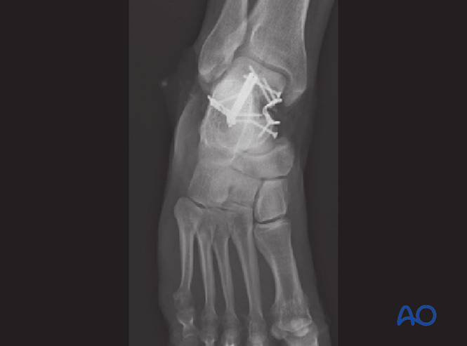 ORIF - Plate fixation for Neck, multifragmentary