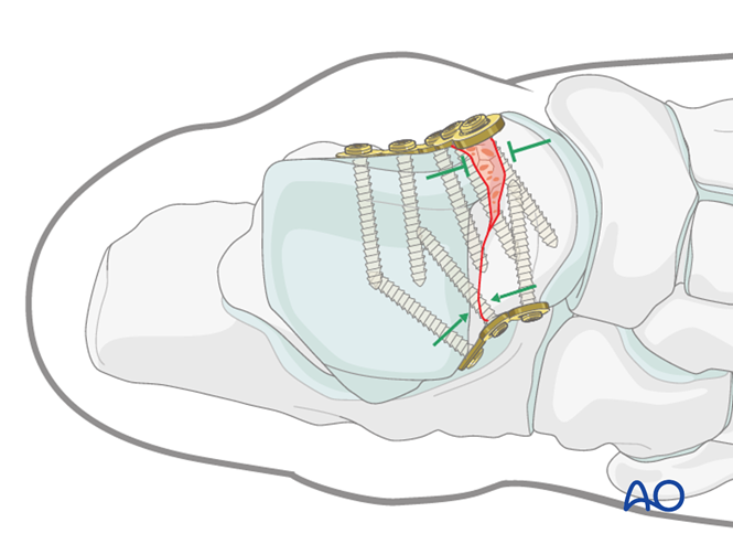 ORIF - Plate fixation for Neck, multifragmentary