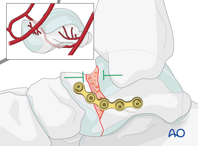 ORIF - Plate fixation for Neck, multifragmentary