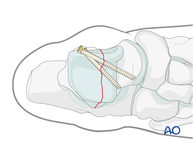 ORIF - Screw and plate fixation for Body