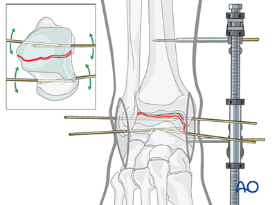 ORIF - Screw and plate fixation for Body