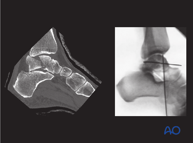 ORIF - Screw and plate fixation for Body
