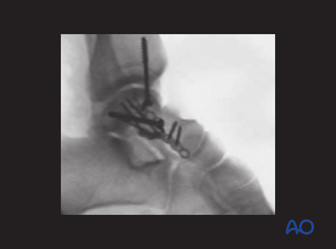 ORIF - Screw and plate fixation for Body