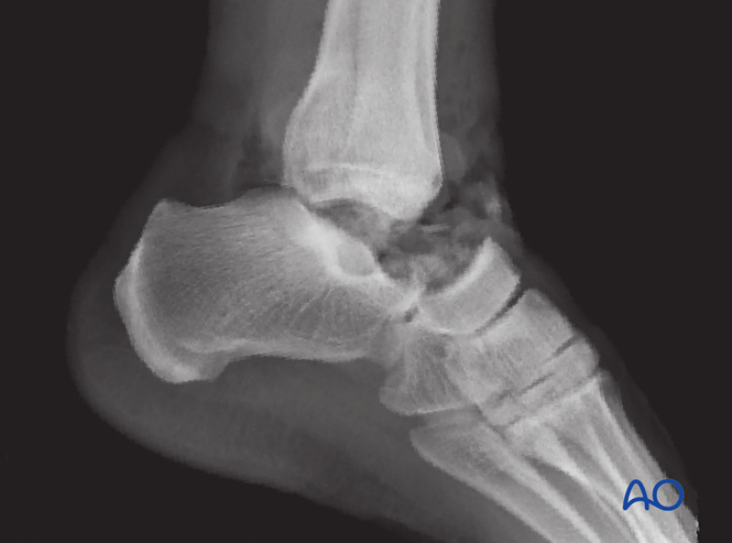 Reinsertion of an extruded talus