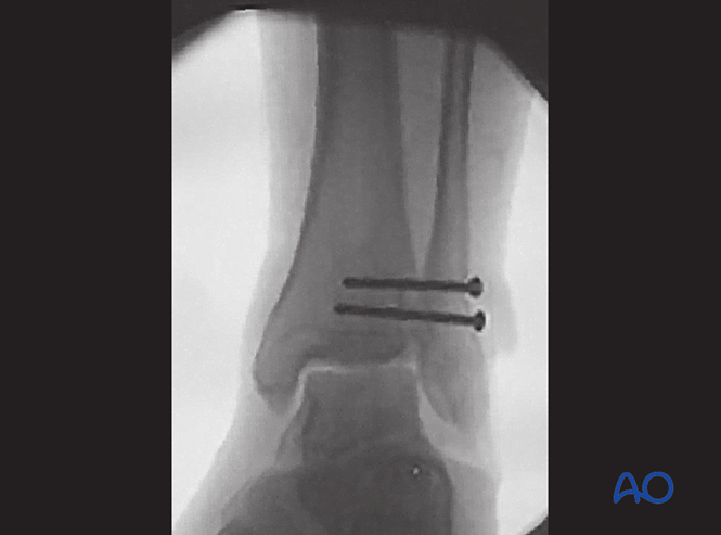 Reinsertion of an extruded talus