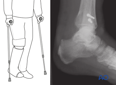 Reinsertion of an extruded talus