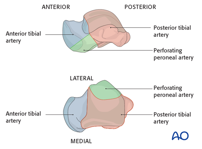 ORIF - Screw and plate fixation for Body