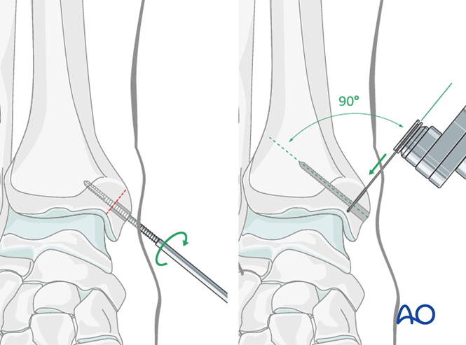 Medial malleolar osteotomy