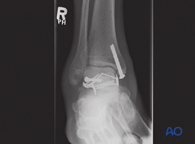 Medial malleolar osteotomy