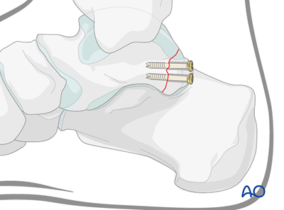 ORIF - Screw fixation for Posterior process