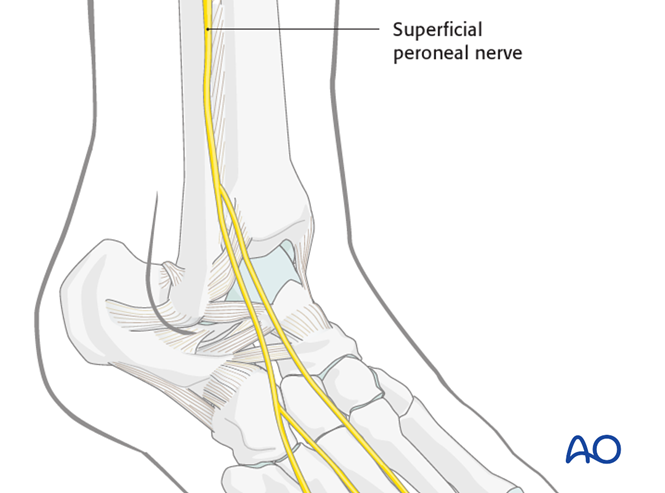 Anterolateral approach to the talus
