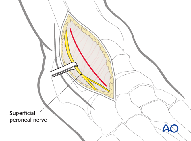 Anterolateral approach to the talus