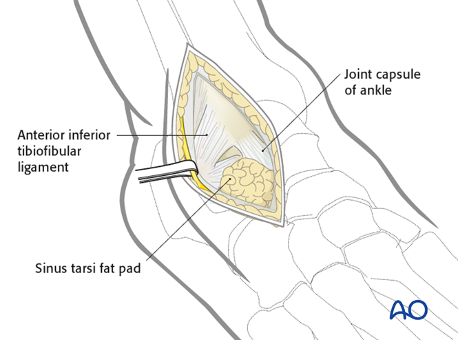 Anterolateral approach to the talus