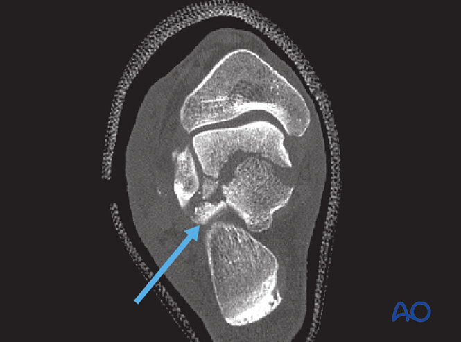 Anterolateral approach to the talus