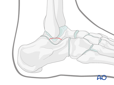 Direct lateral approach to the talus