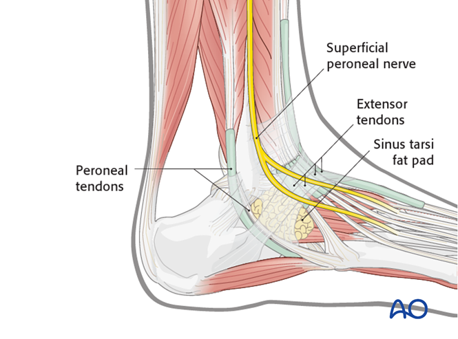 Direct lateral approach to the talus