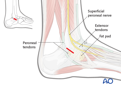 Direct lateral approach to the talus