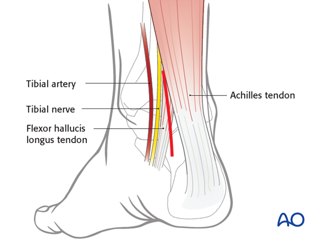 Posteromedial approach to the talus