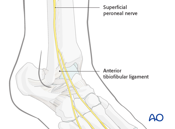 Lateral malleolar osteotomy
