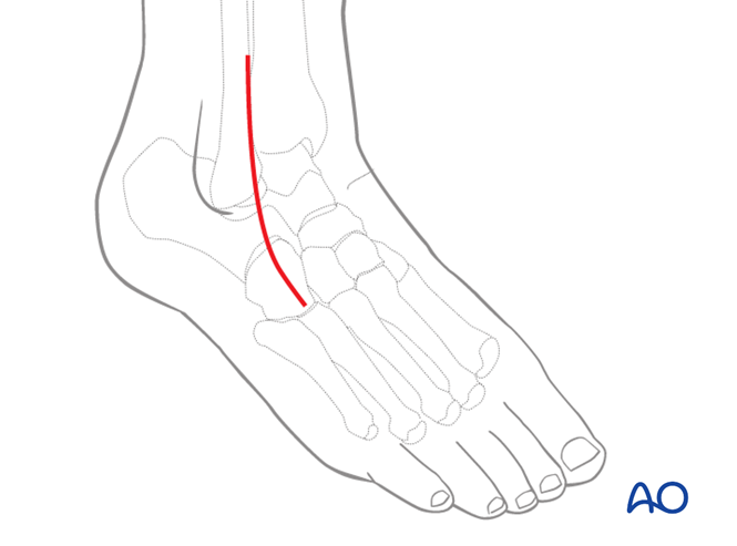 Lateral malleolar osteotomy