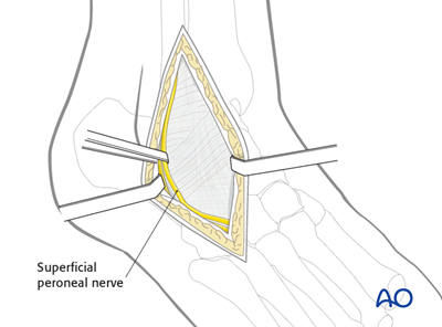 Lateral malleolar osteotomy