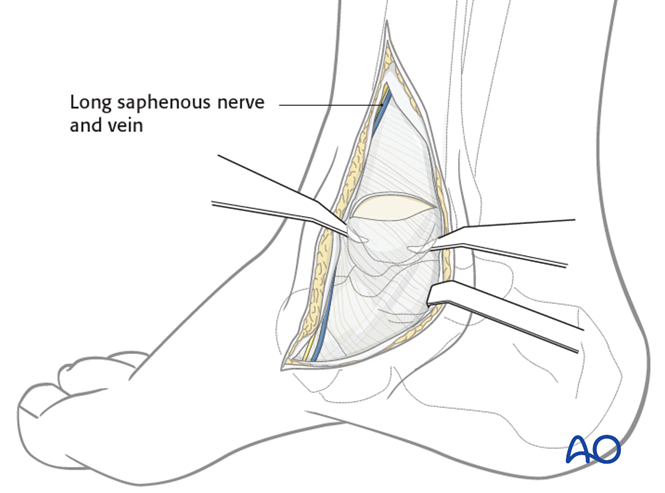 Medial malleolar osteotomy