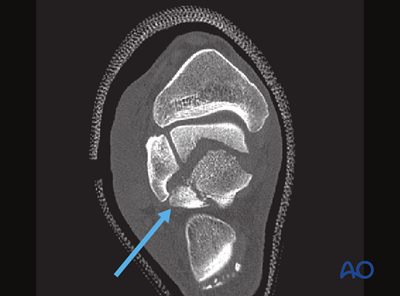 Posterolateral approach to the hindfoot