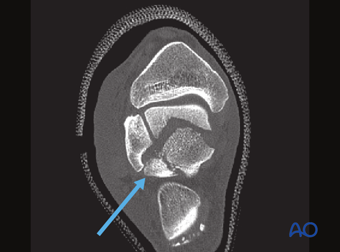 Posterolateral approach to the hindfoot