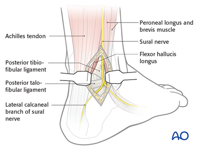 Posterolateral approach to the hindfoot