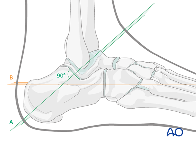 Nonoperative treatment for Simple undisplaced fracture of the calcaneus ...